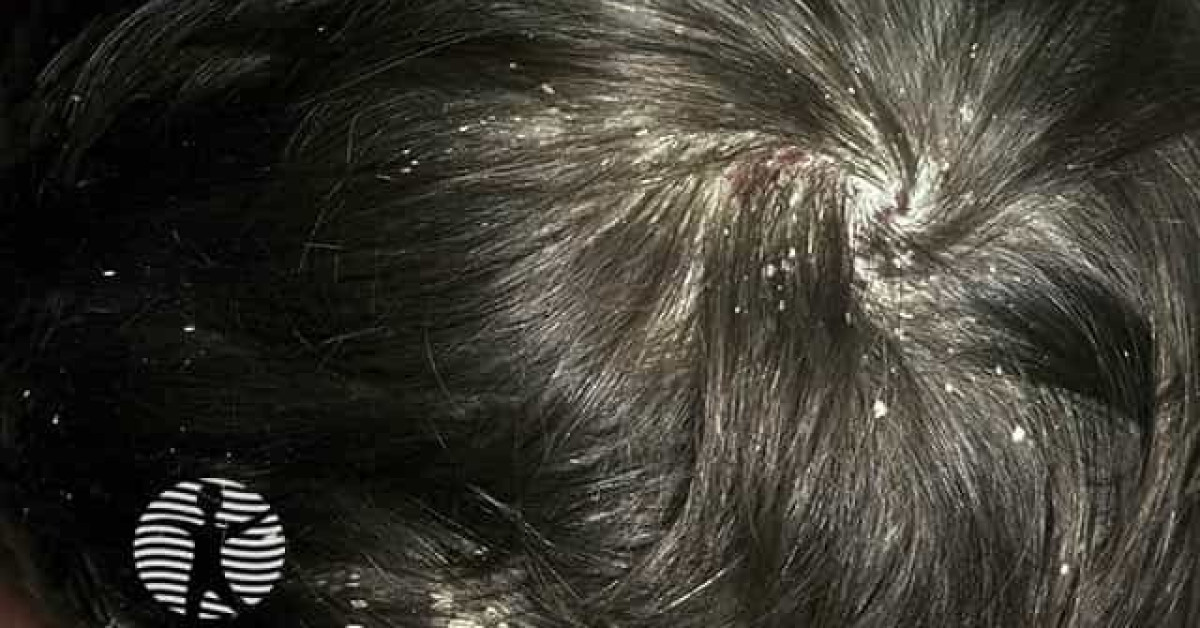 Scalp psoriasis image