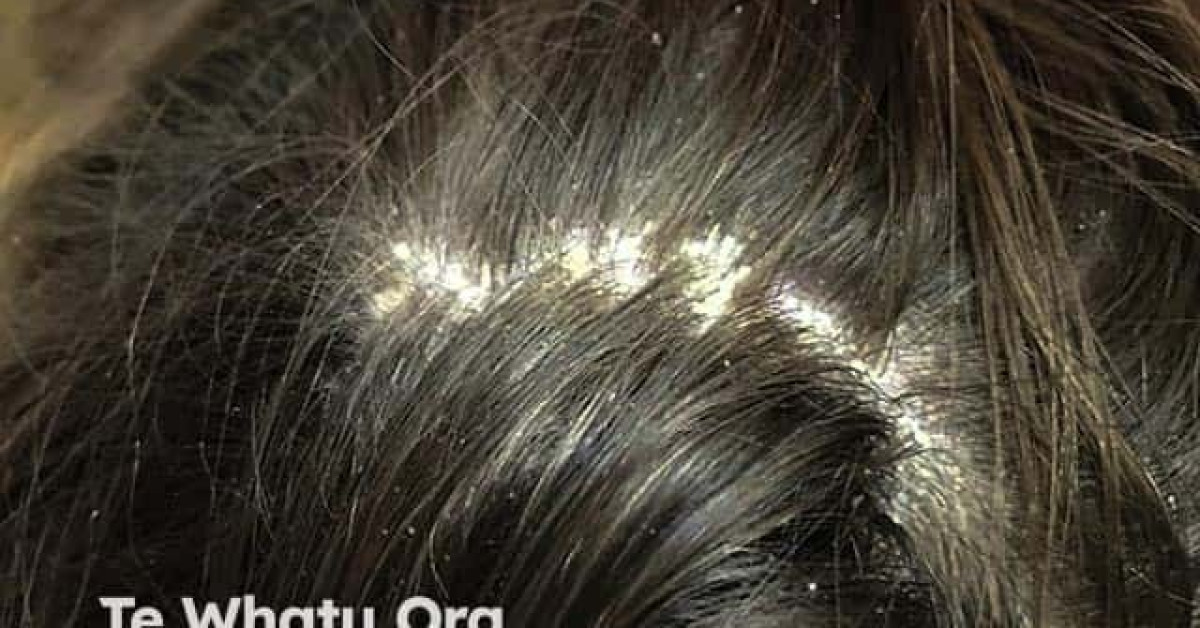 Scalp psoriasis image