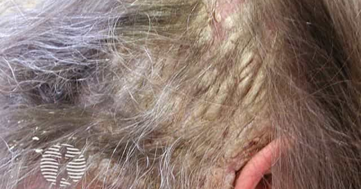 Scalp psoriasis image