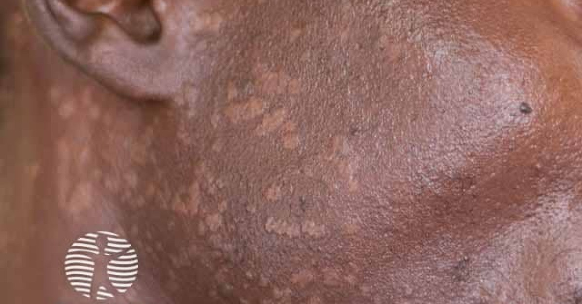 Seborrhoiec dermatitis image