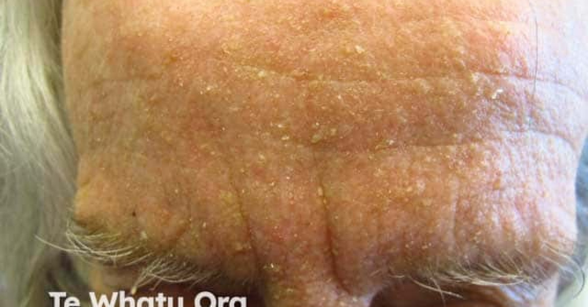 Seborrhoiec dermatitis image