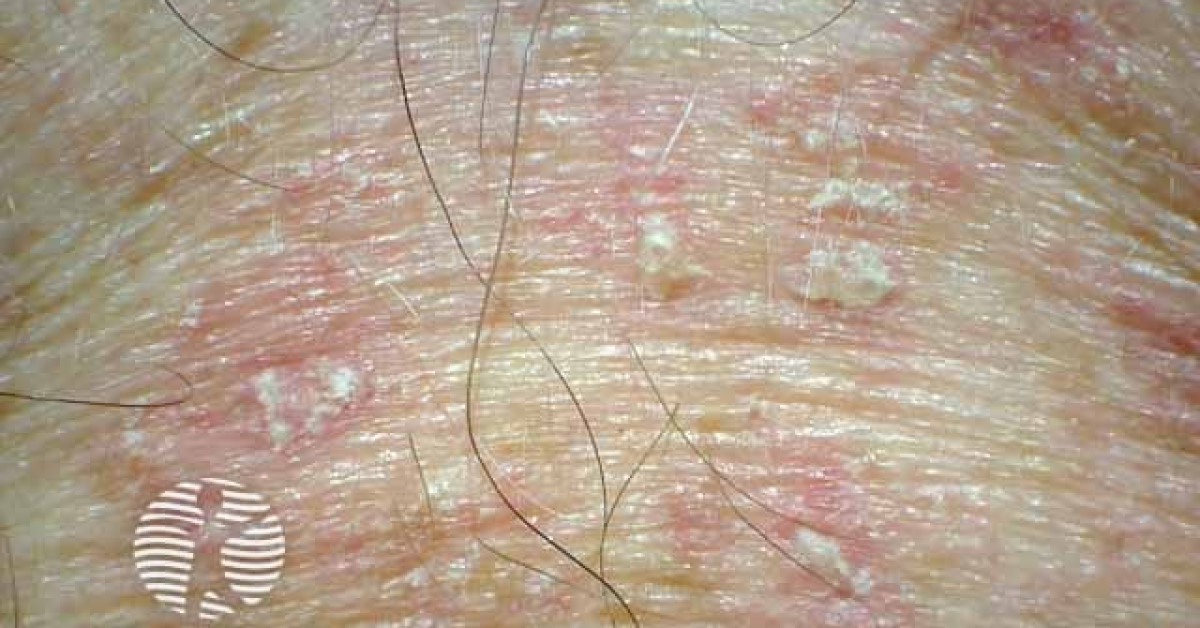Seborrhoiec dermatitis image