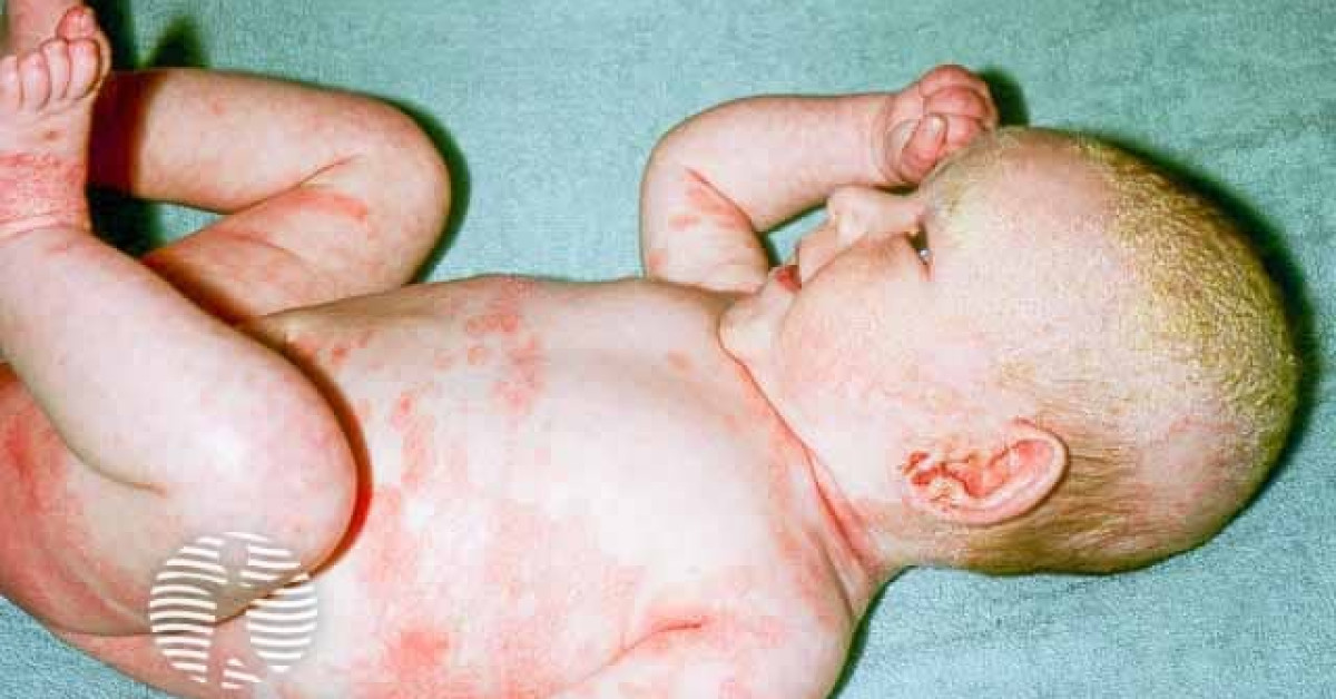 Seborrhoiec dermatitis image