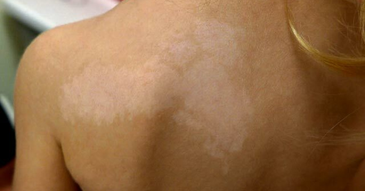 Segmental pigmentation disorder image