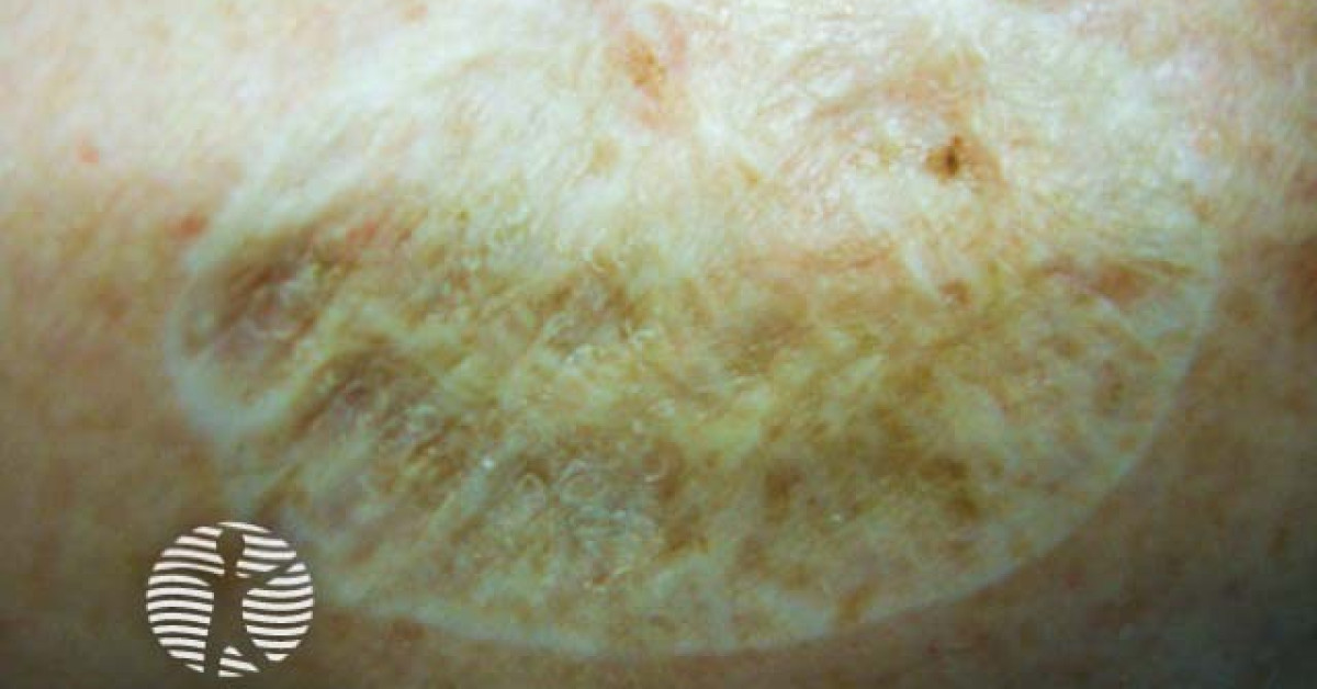Skin graft image