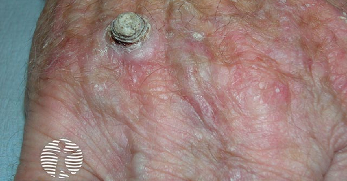 Squamous cell carcinoma image