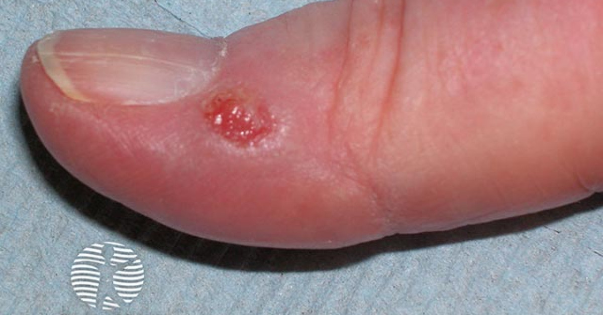 Squamous cell carcinoma image