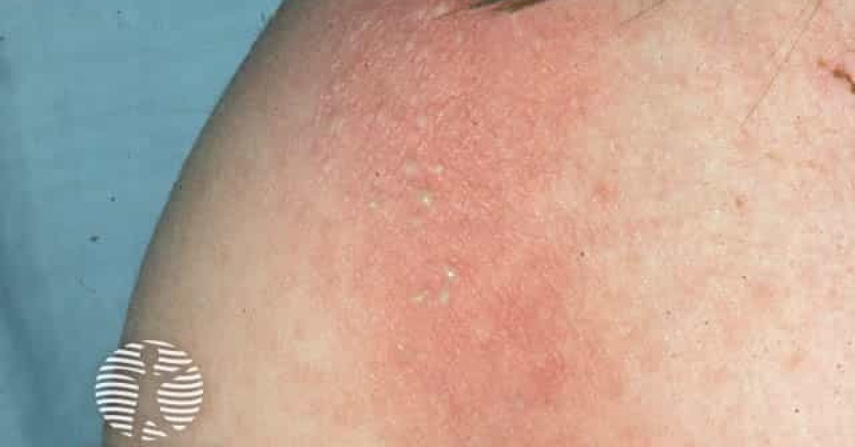 Staphylococcal scalded skin syndrome image