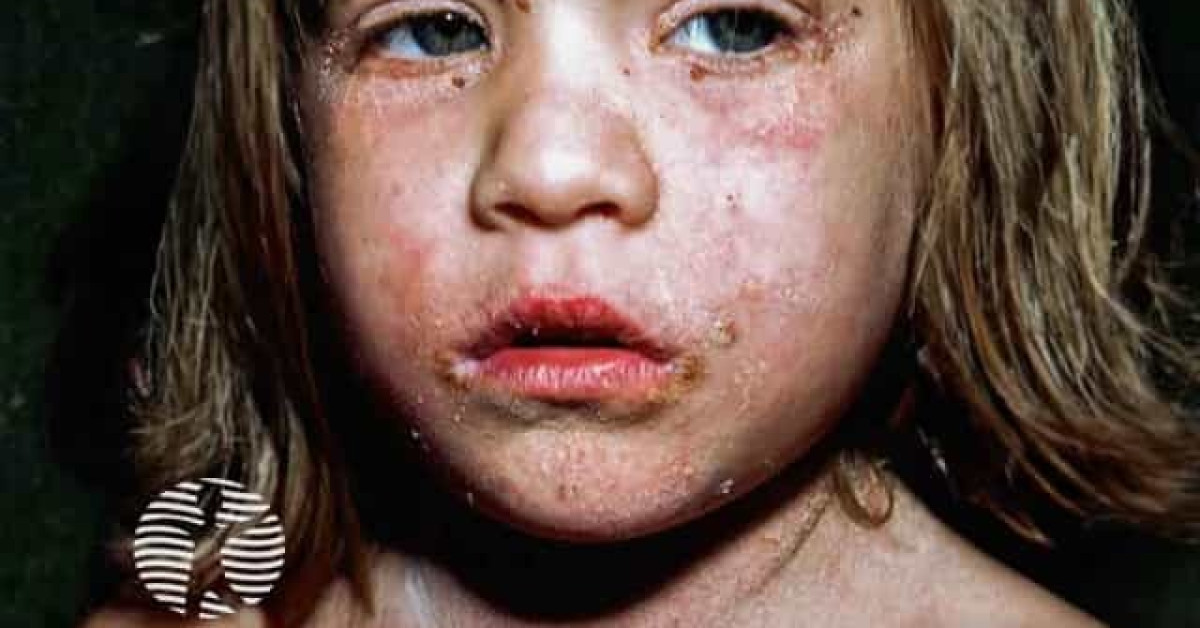 Staphylococcal scalded skin syndrome image