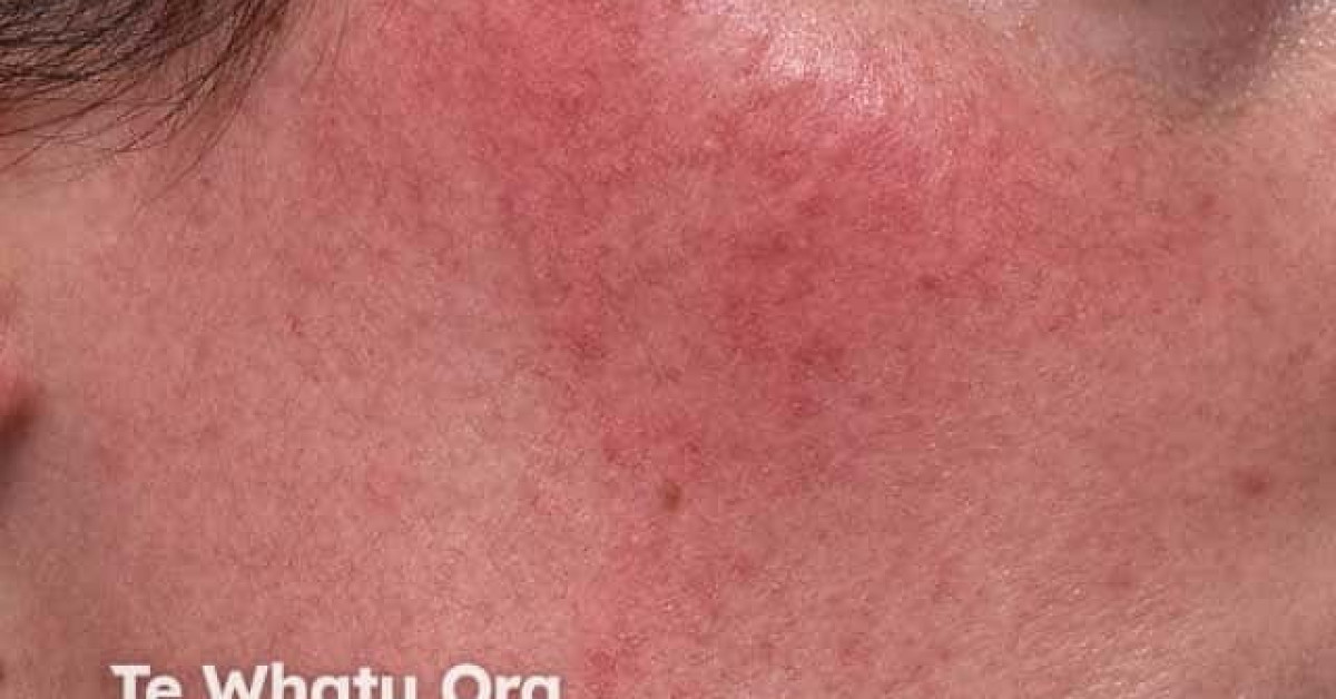 Steroid Rosacea Image