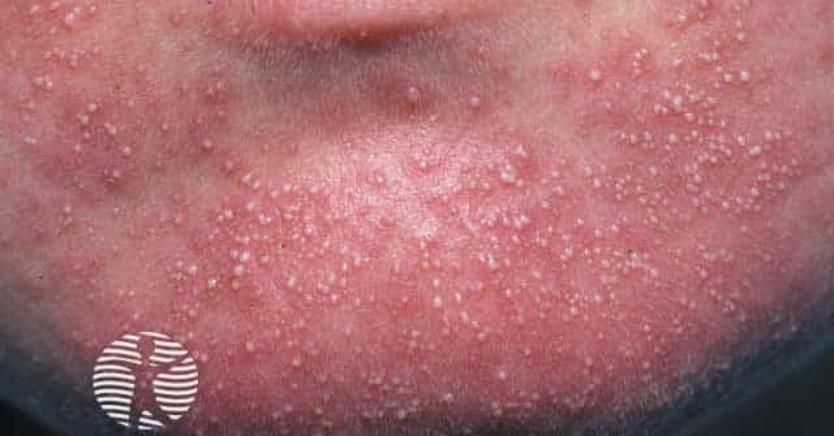 Steroid rosacea image