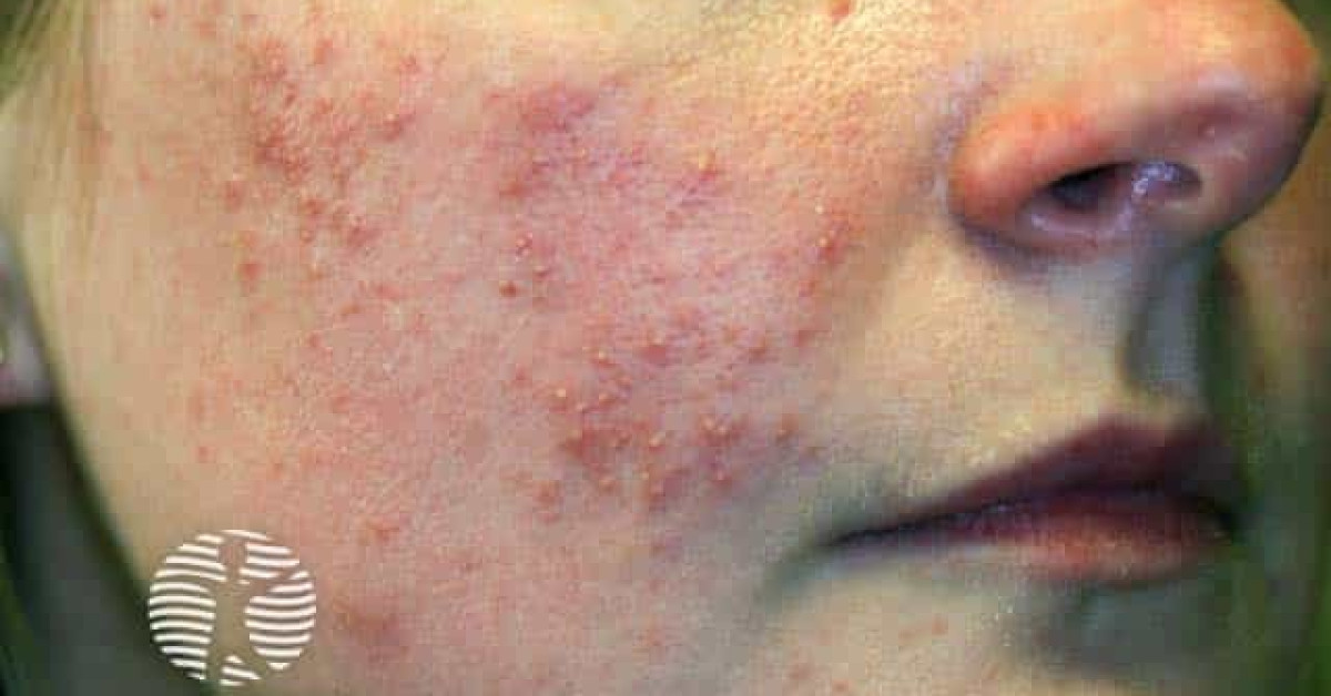 Steroid rosacea image