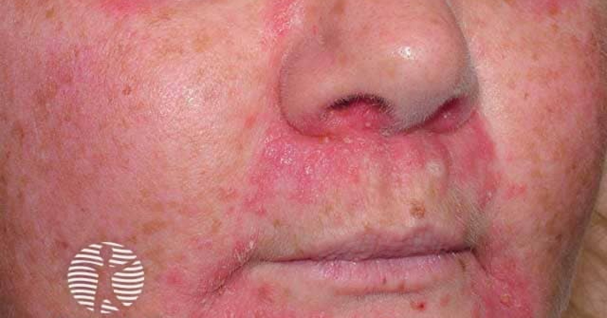 Steroid rosacea image