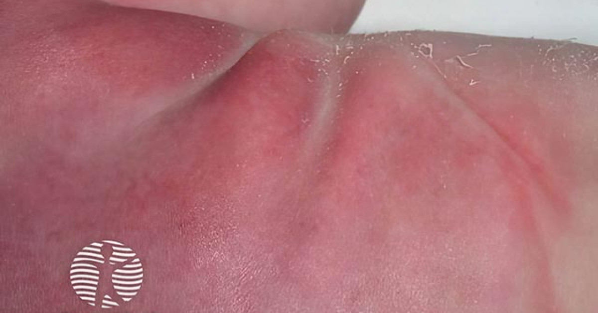 Subcutaneous fat necrosis of the newborn image