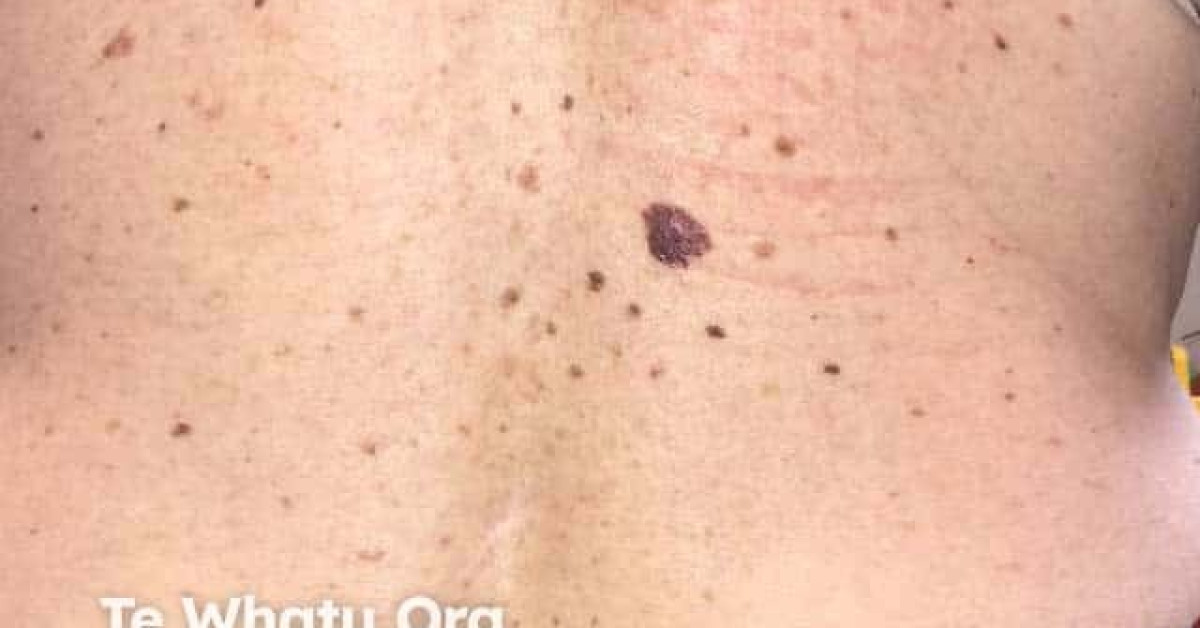 Superficial spreading melanoma image