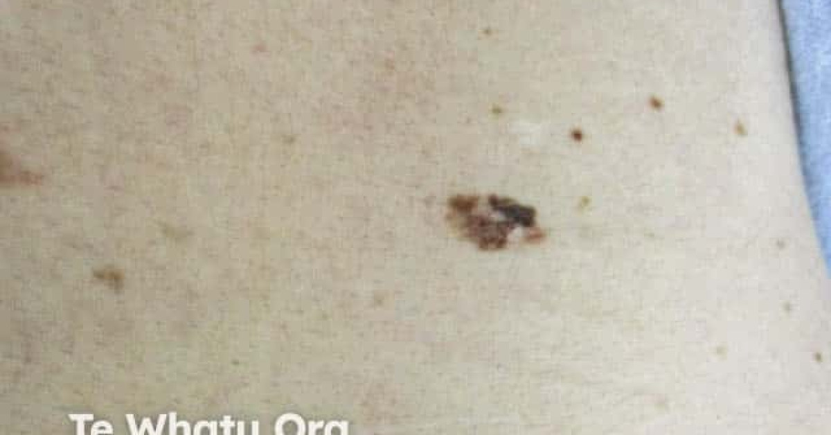 Superficial spreading melanoma image