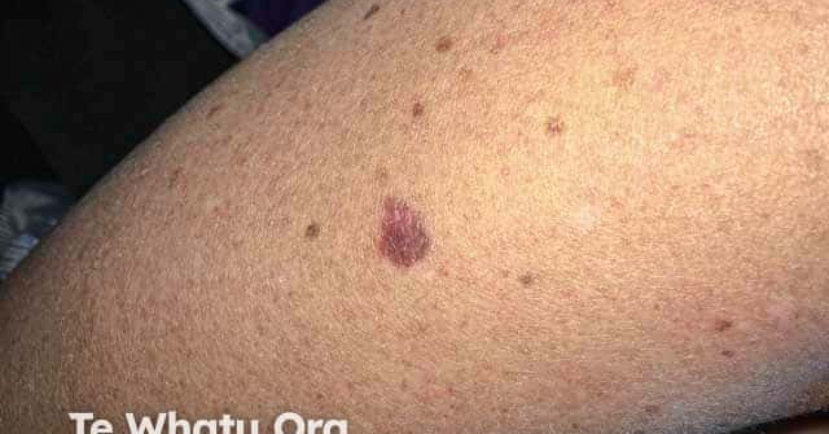 Superficial spreading melanoma image
