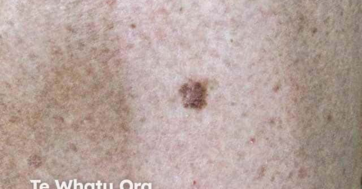 Superficial spreading melanoma image