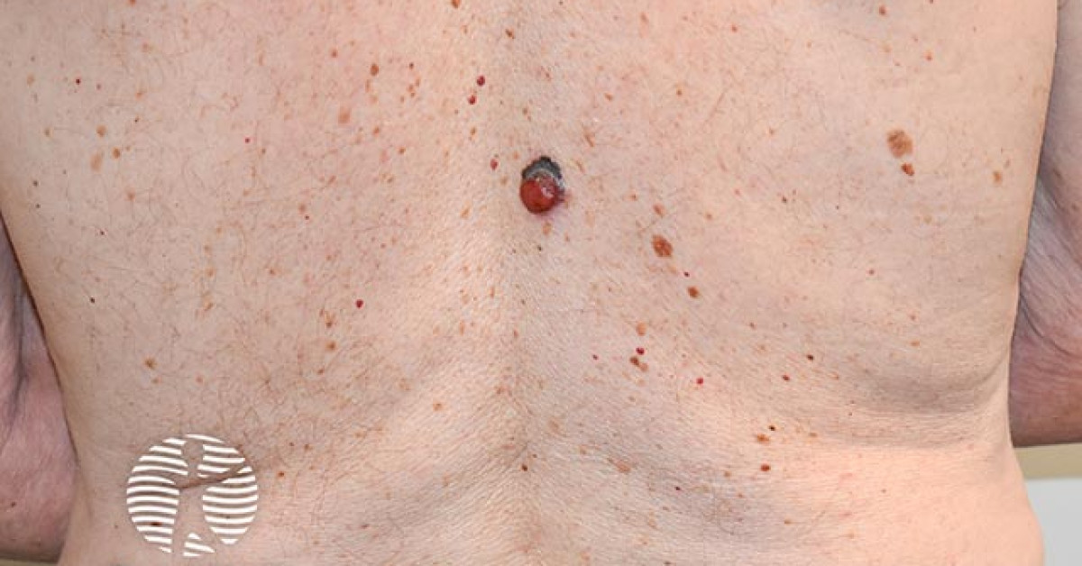 Superficial spreading melanoma image