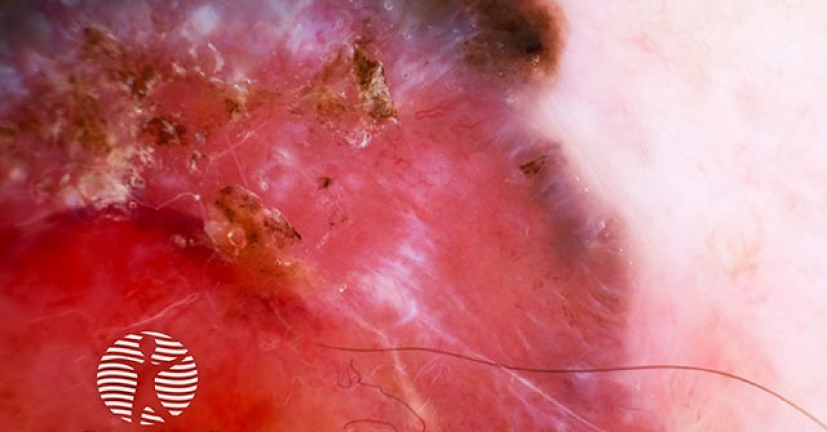 Superficial spreading melanoma image