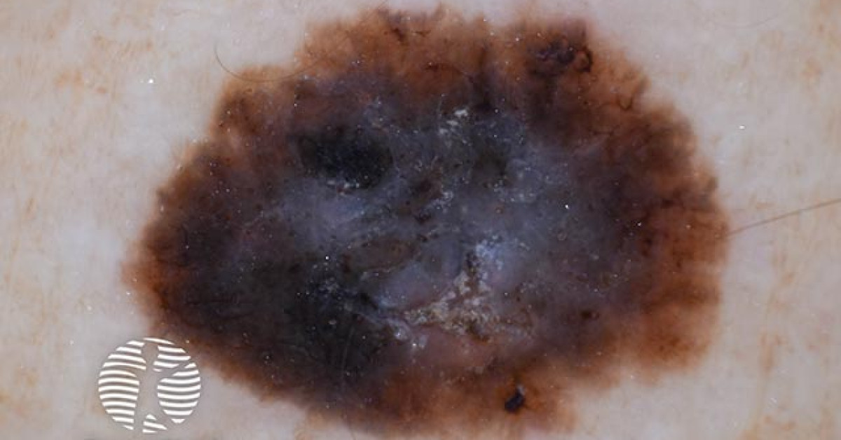 Superficial spreading melanoma image