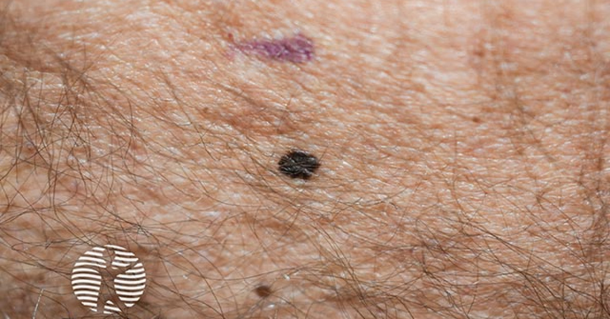 Superficial spreading melanoma image