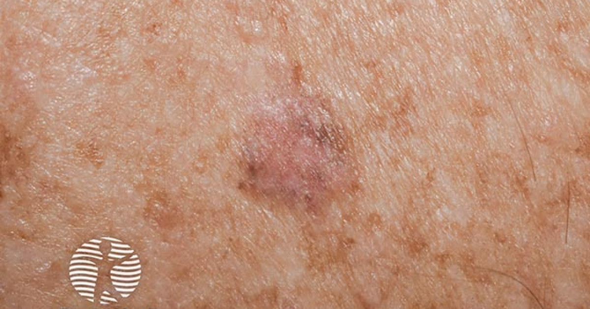 Superficial spreading melanoma image