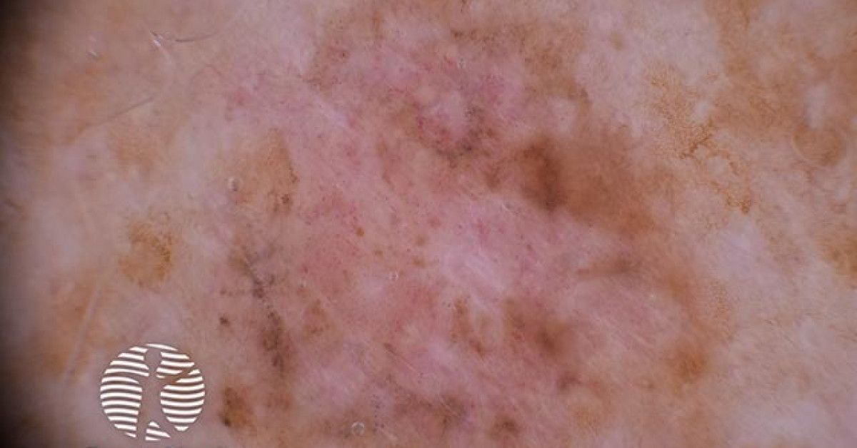 Superficial spreading melanoma image