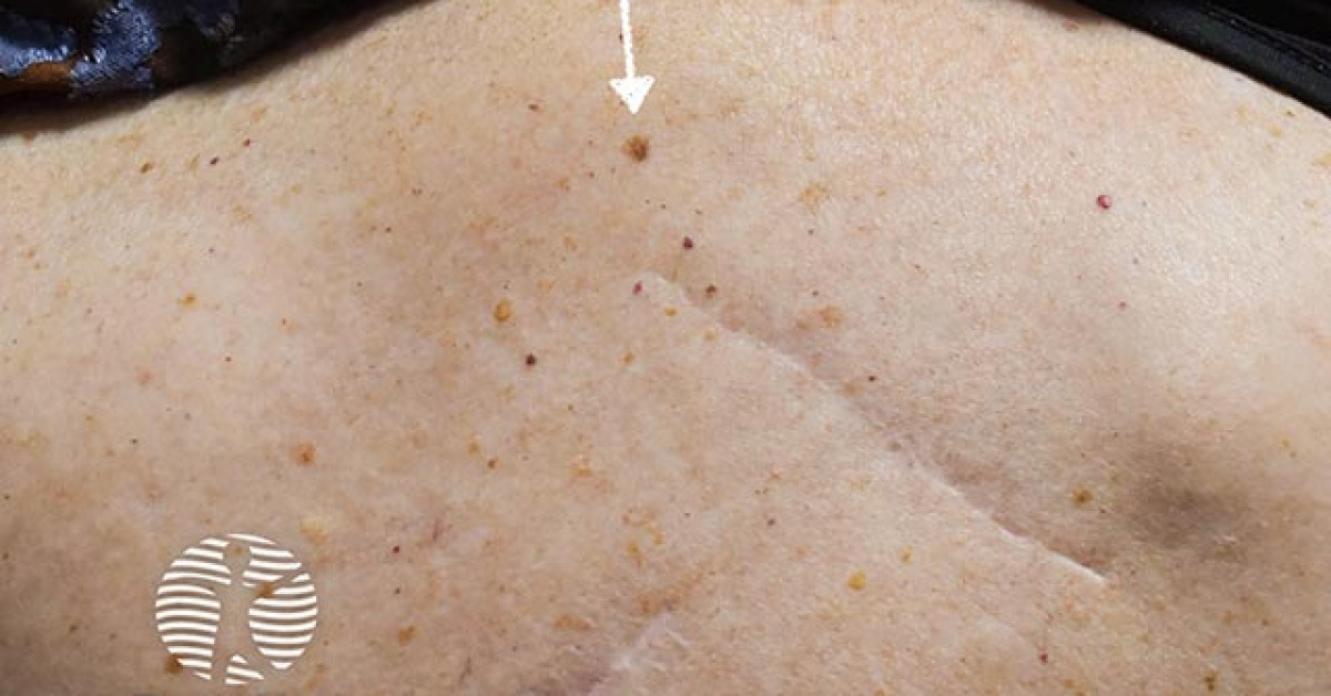 Superficial spreading melanoma image