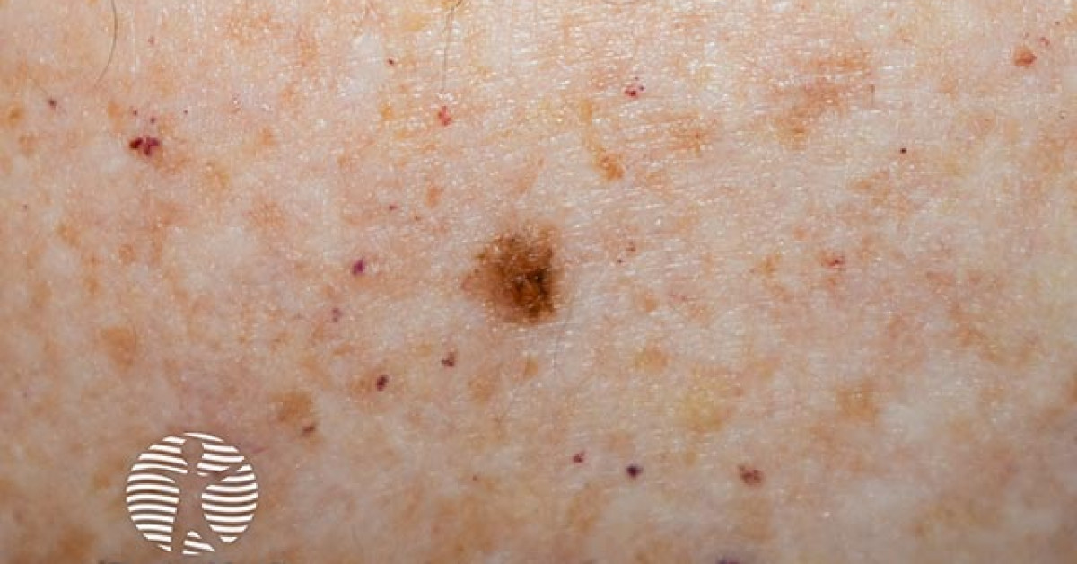 Superficial spreading melanoma image