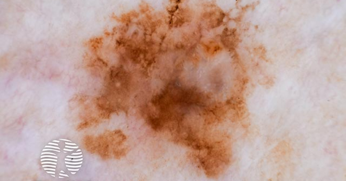Superficial spreading melanoma image