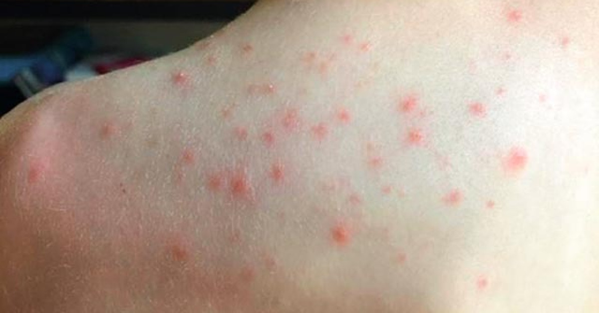 Swimmer's itch image