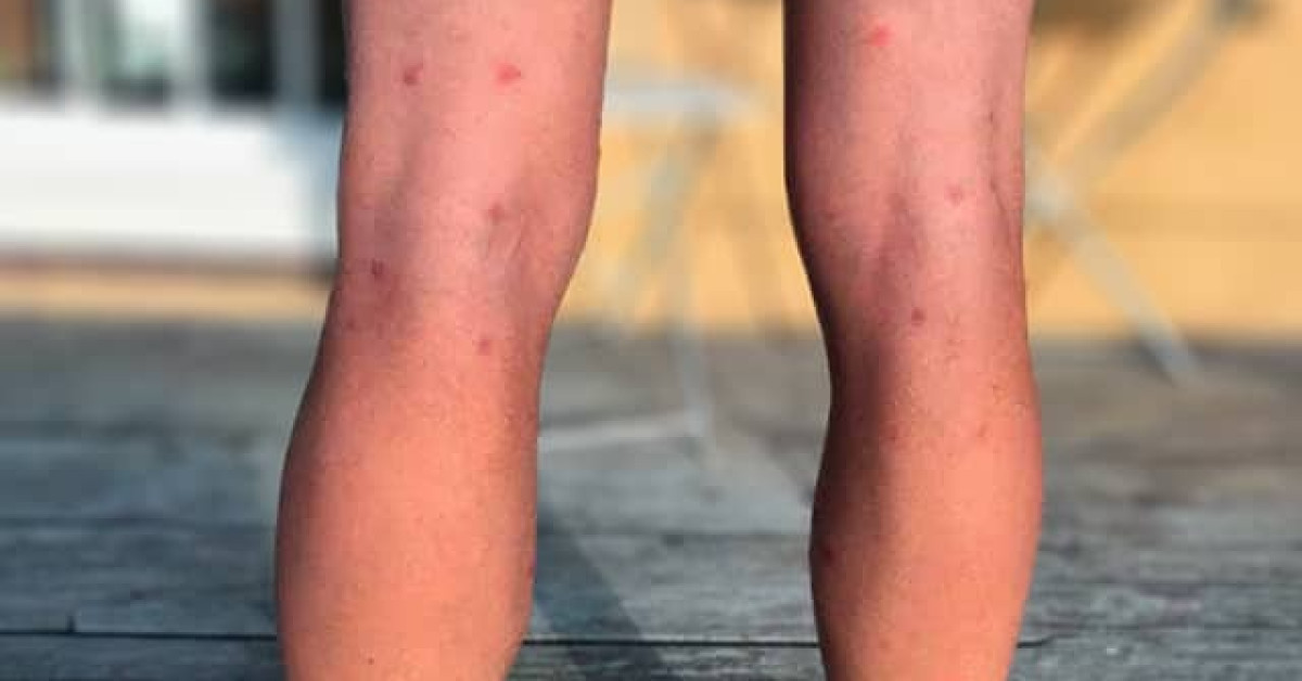 Swimmer's itch image