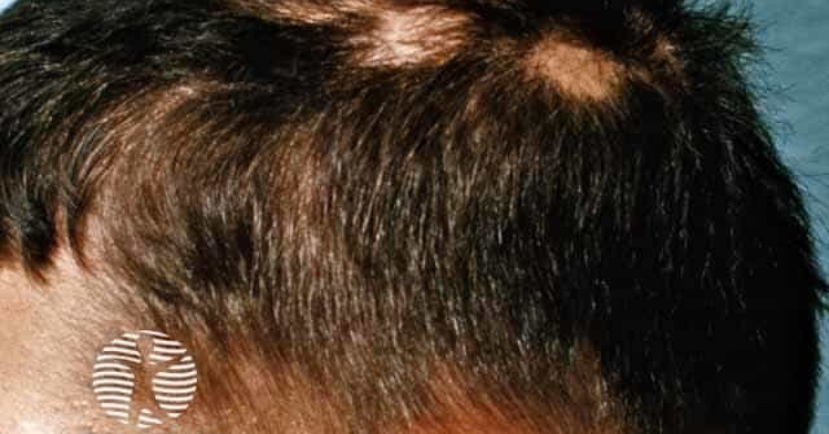 Syphilis image