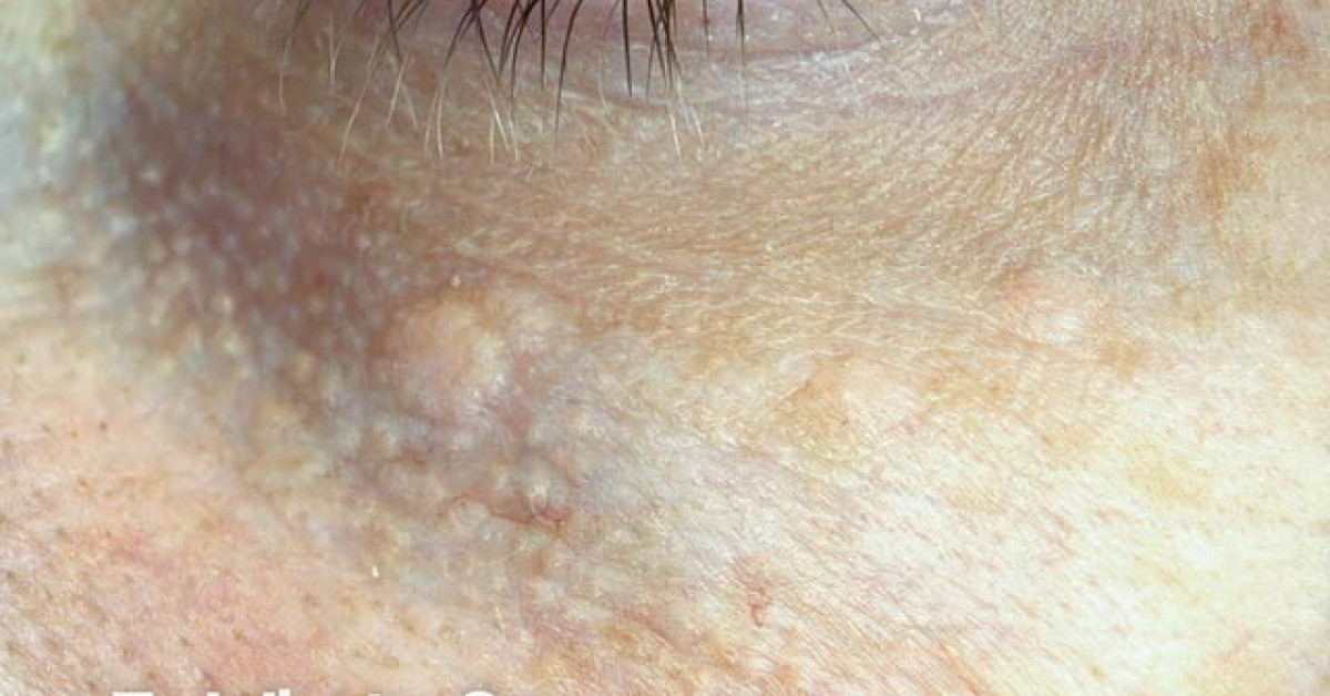Syringoma image