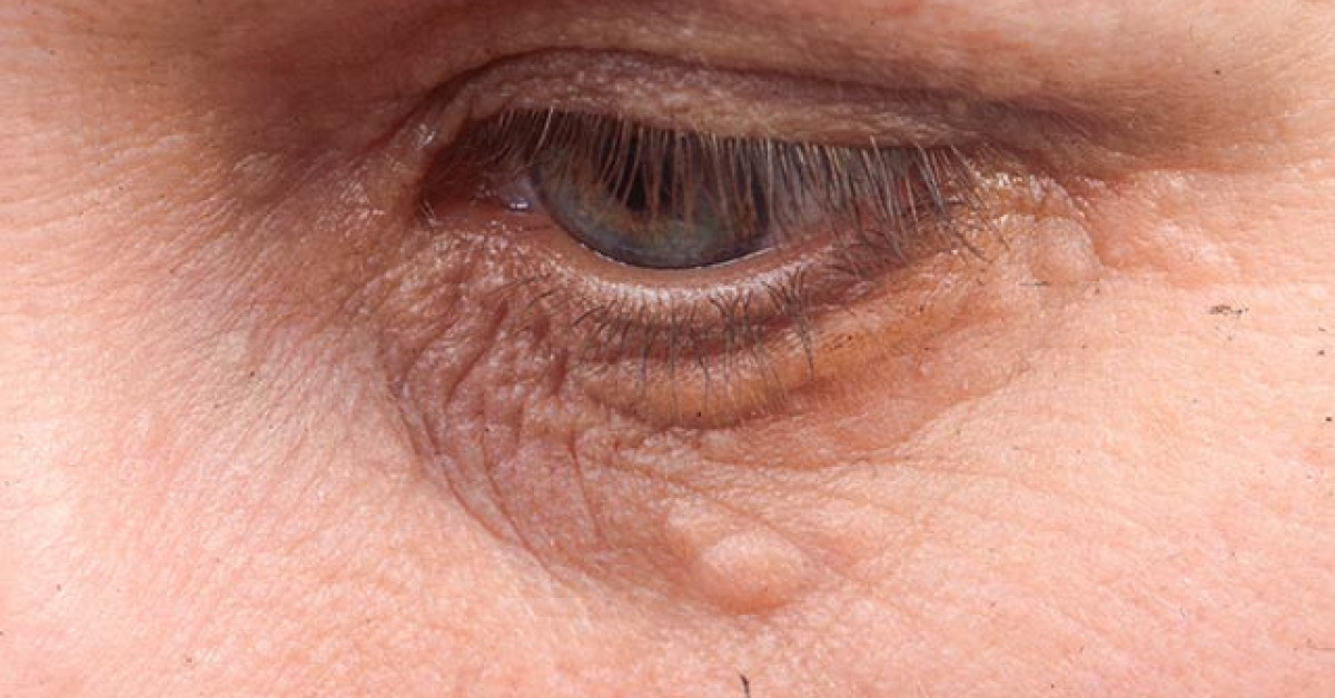 Syringoma image