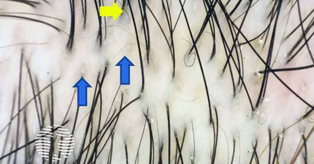 Telogen effluvium image