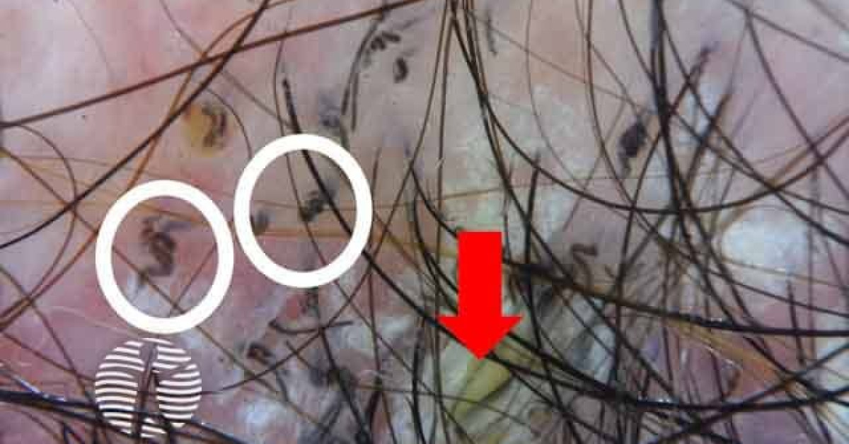 Tinea capitis image
