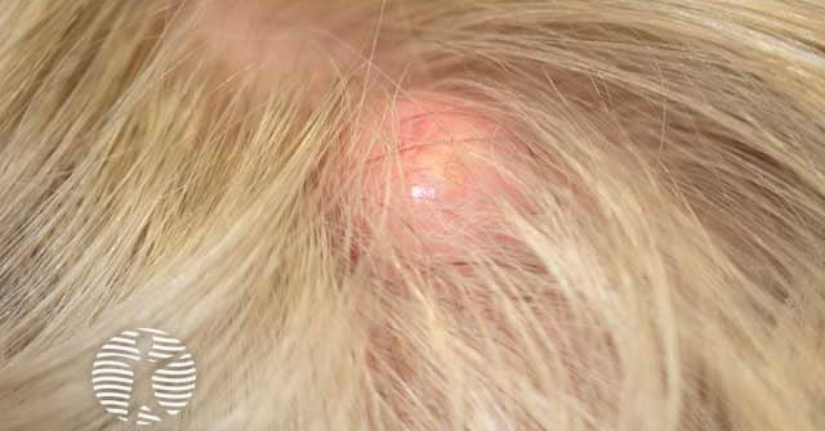 Trichilemmal cyst image