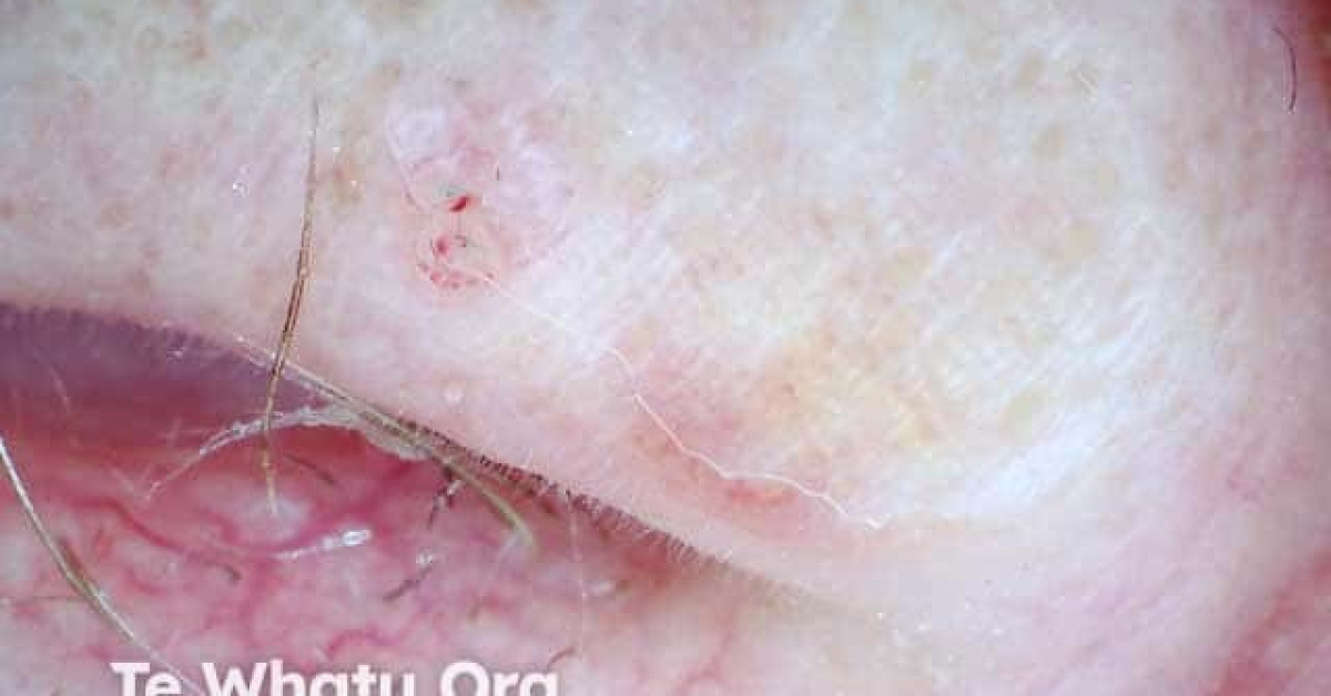 Trichilemmal cyst image