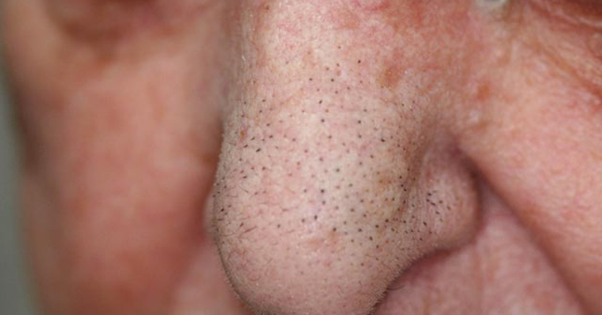 Trichostasis Spinulosa Home Remedy