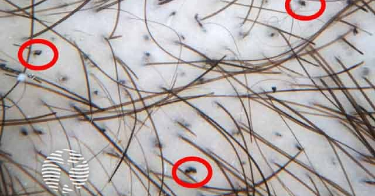 Trichotillomania image