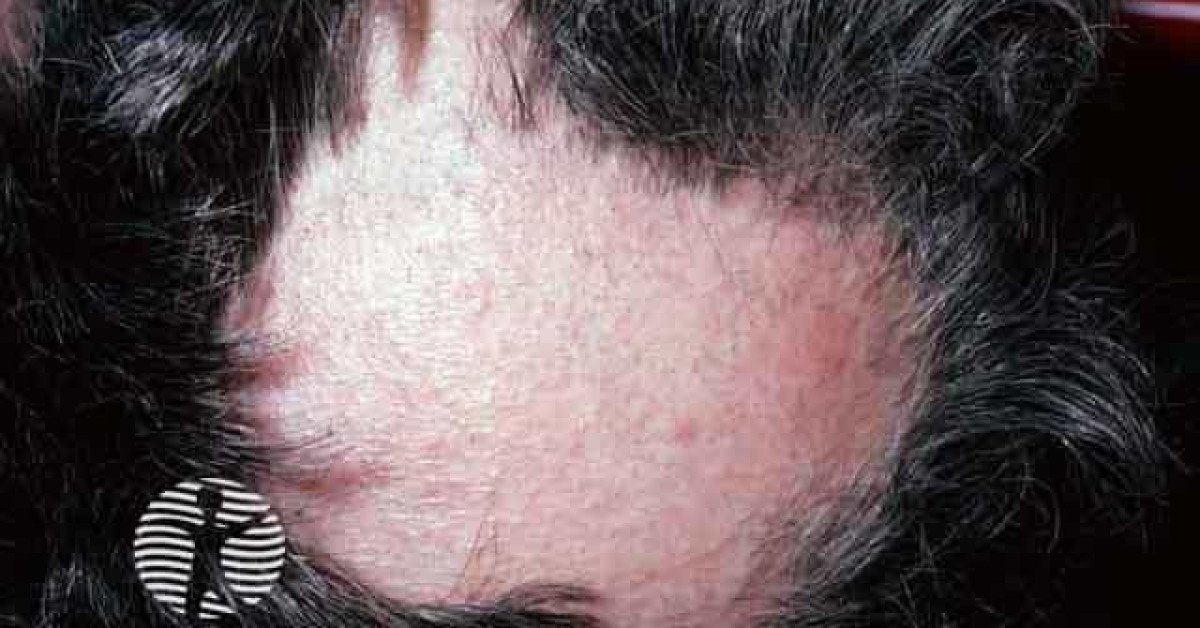 Trichotillomania image