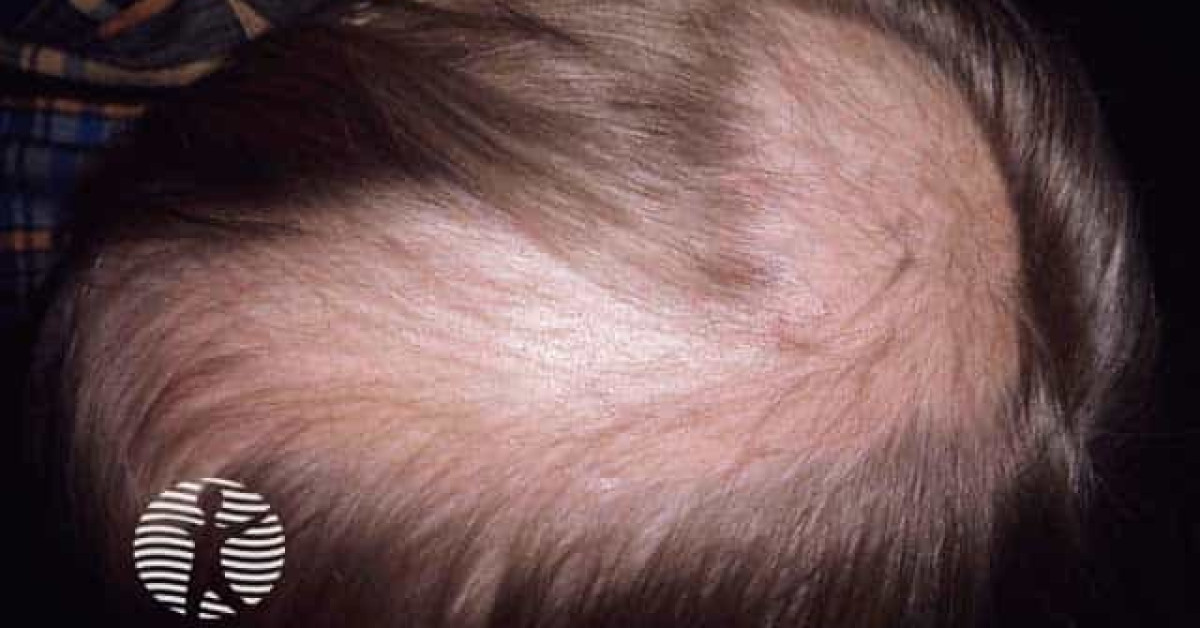 Trichotillomania image