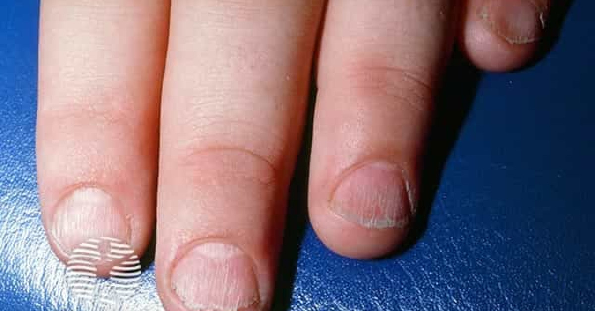 Twenty nail dystrophy image