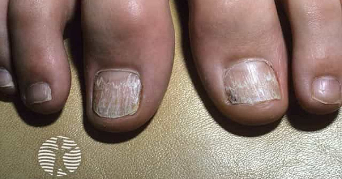 Twenty nail dystrophy image