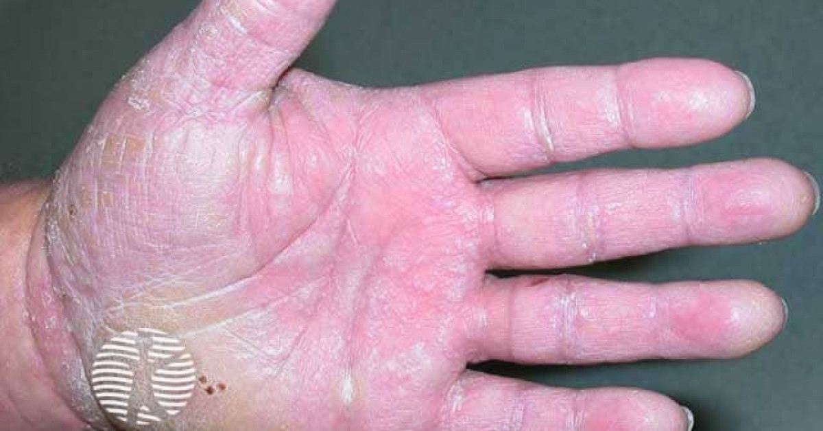 Vesiculobullous lichen planus image