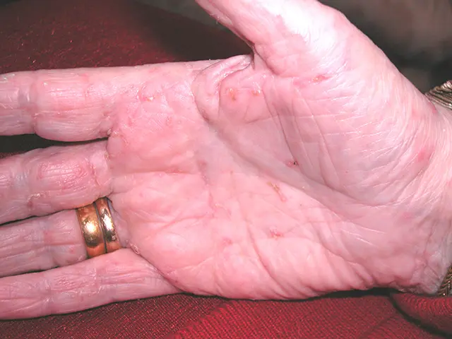 DermNet® - Dermatology Resource