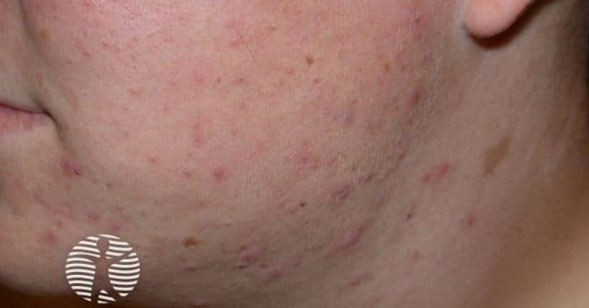 DermNet® - acne2 image