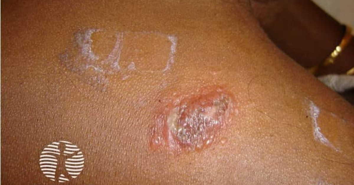 leishmaniasis3 image